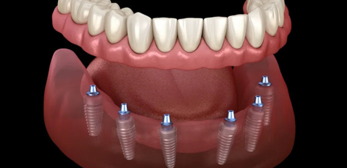 Choose dental implants as the best solution for missing teeth